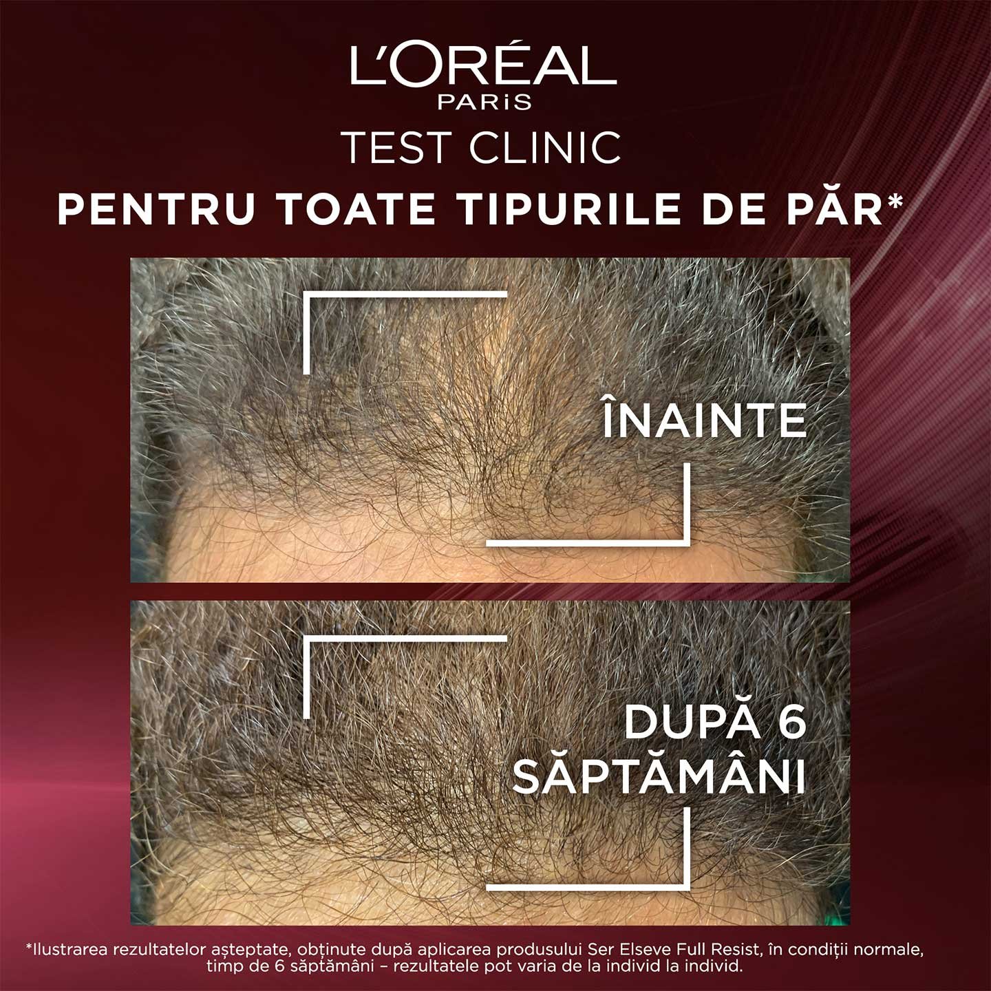 Serum Elseve Full Resist cu Aminexil - Pentru că merităm
